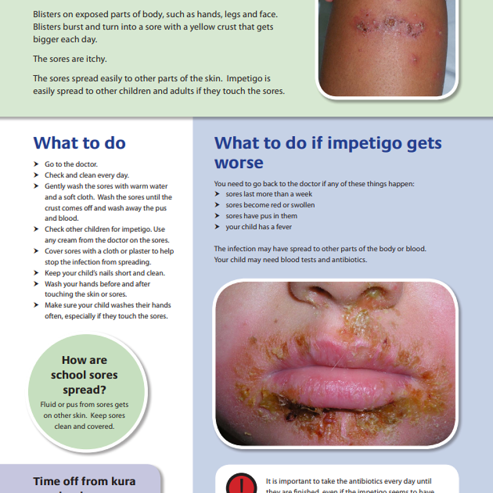 Impetigo (school sores)